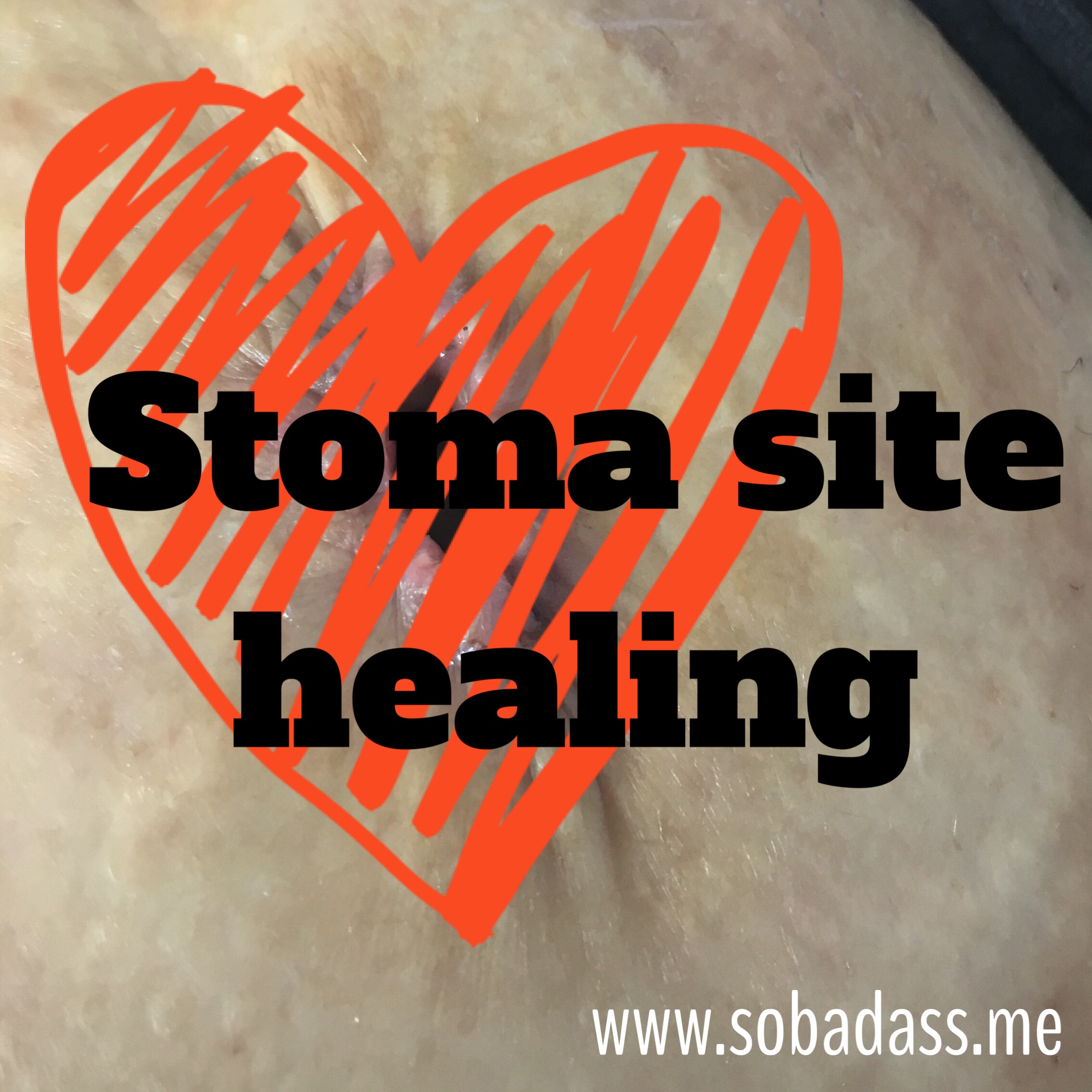 Healing an old stoma site from the inside out! - So Bad Ass
